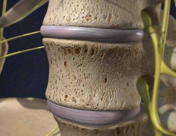 Degenerative Disc Disease | Causes, Symptoms, and Treatments