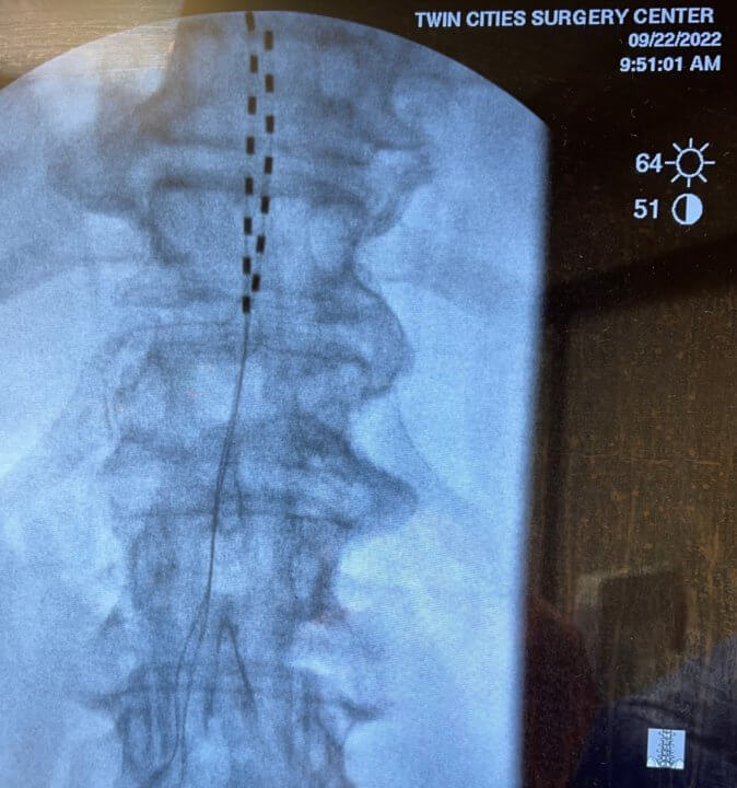 Dr. Sherri Haas Implants New Spinal Cord Stimulator by Abbott