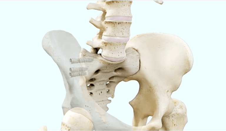 Comparing SI Joint Fusion Options | Twin Cities Pain Clinic