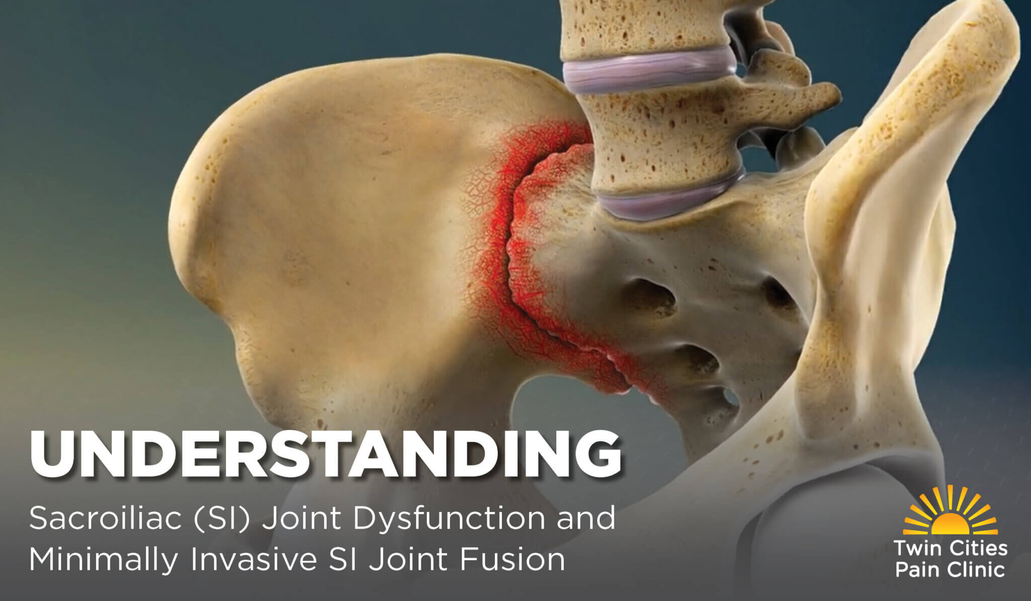 Understanding SI Joint Dysfunction & Minimally Invasive Fusion