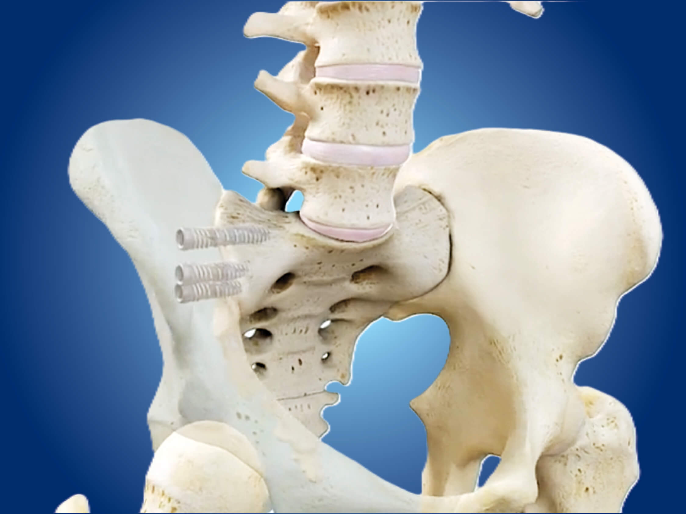 Minimally Invasive SI Joint Fusion | Twin Cities Pain Clinic
